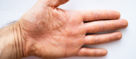 Dermatitida na rukou - jak se chránit | Inhand.cz